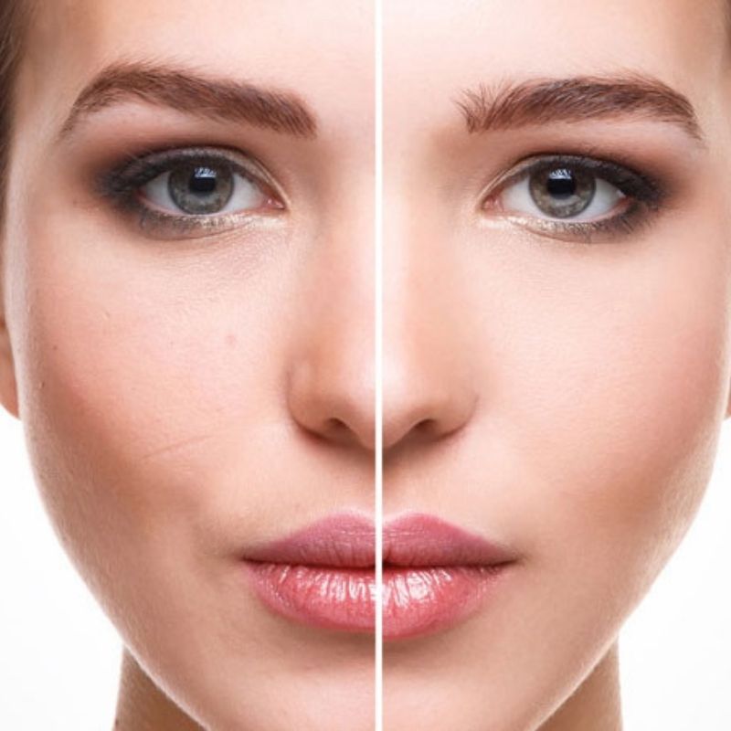 BB Glow Korean Facial - Korean BB Glow Blush Procedure – AZPMU