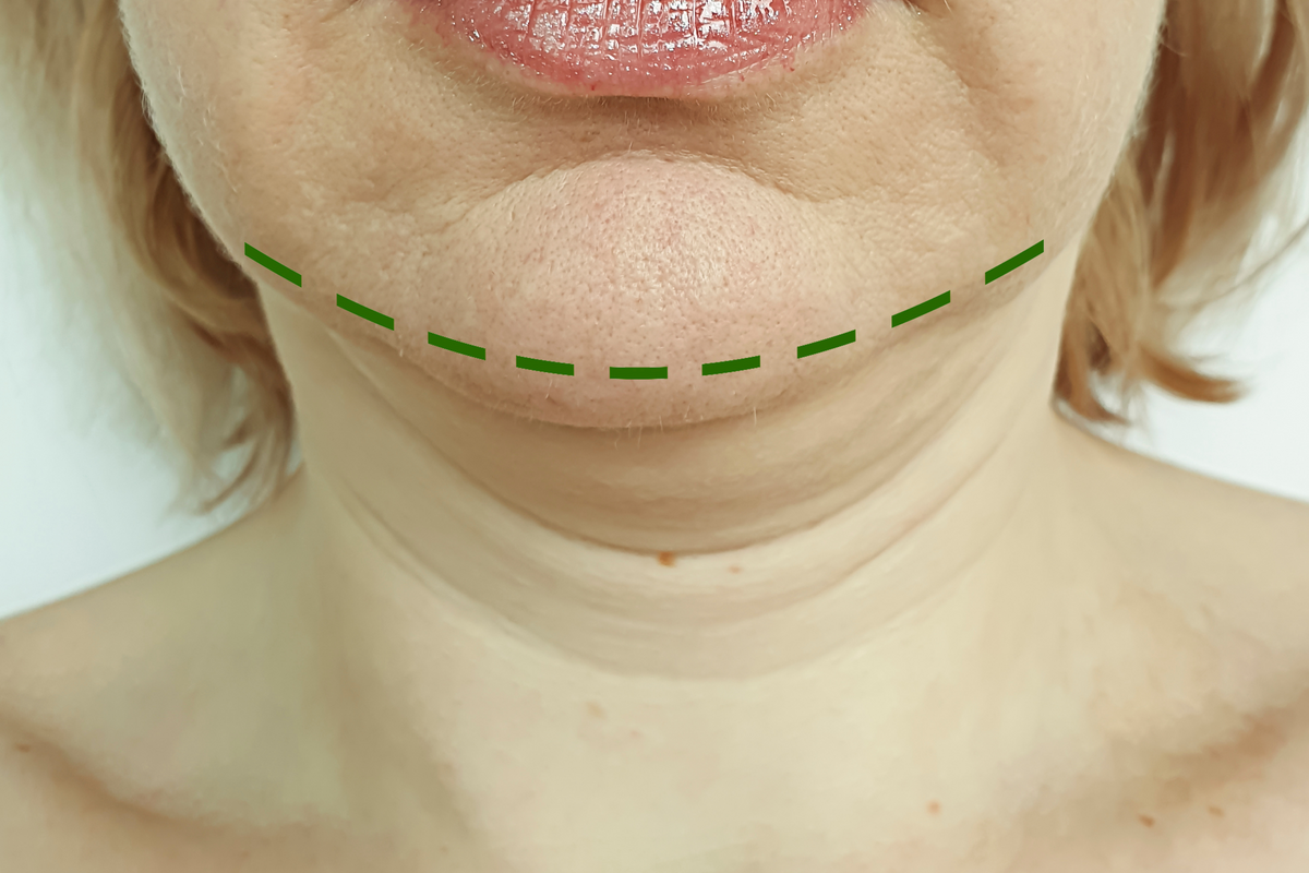 Fat Dissolve Under Chin Area – AZPMU